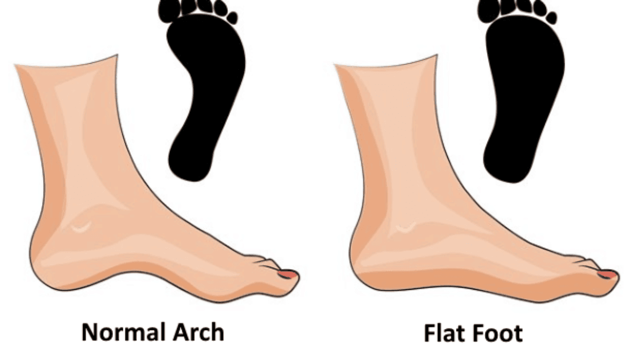 Basics of Anatomy: Arches of the Foot - Moushu's Pilates